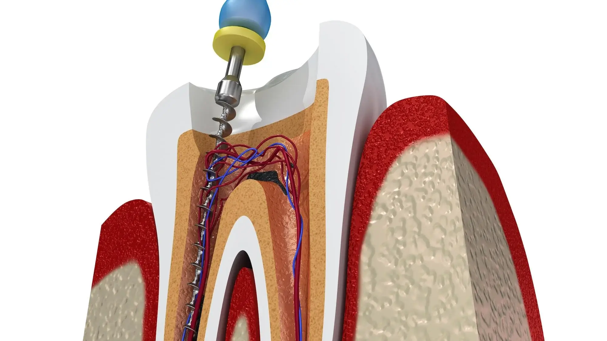Why Does Root Canal Treatment Fail? - Frigdent